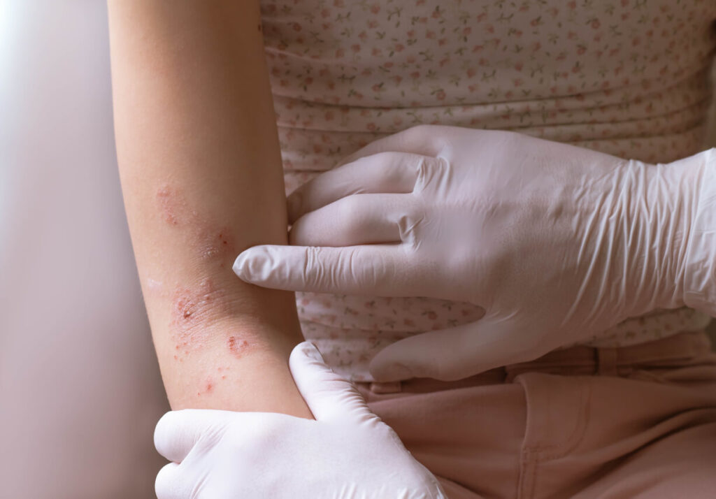 Most Common Skin Rashes Among Adults - Georgia Skin Cancer and ...
